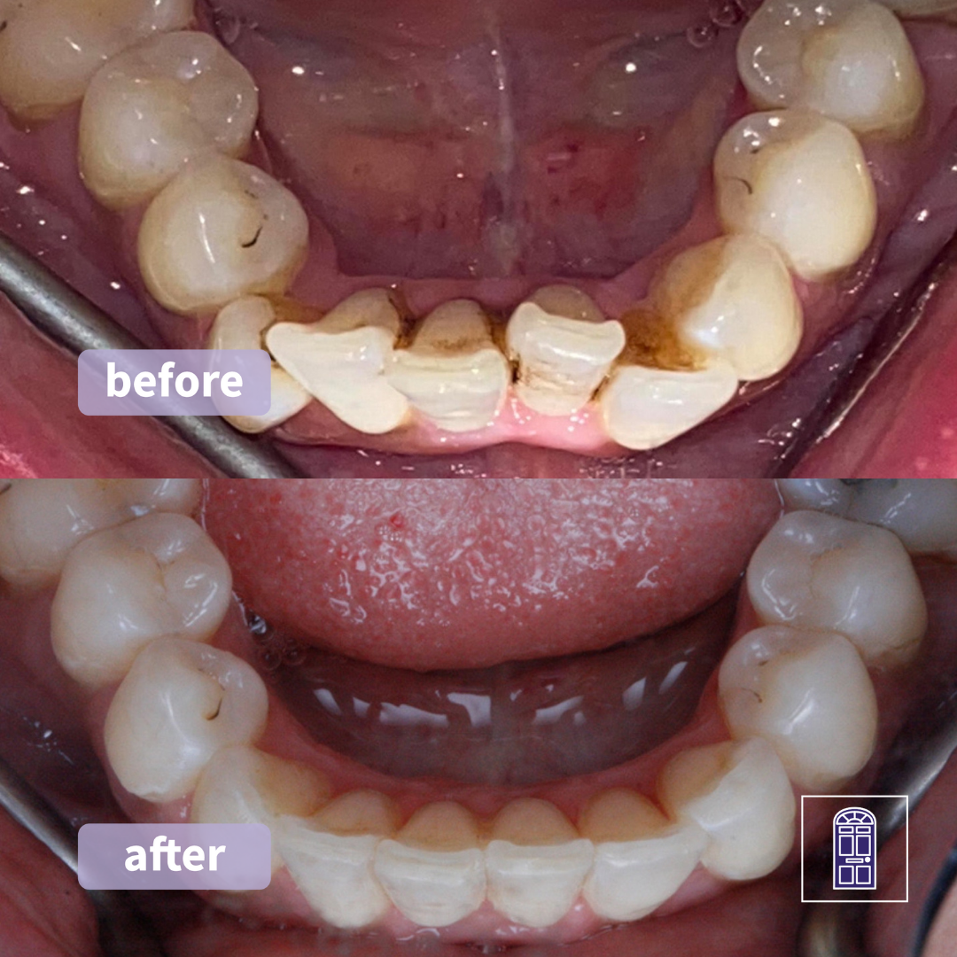 Invisalign Open Day in York, Knaresborough, Harrogate & Yorkshire
